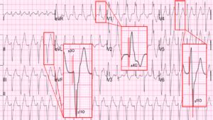 Vt Versus Svt Deel Ecg Academie