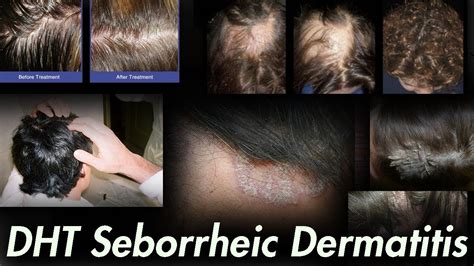 Seborrheic Dermatitis Scalp Hair Loss