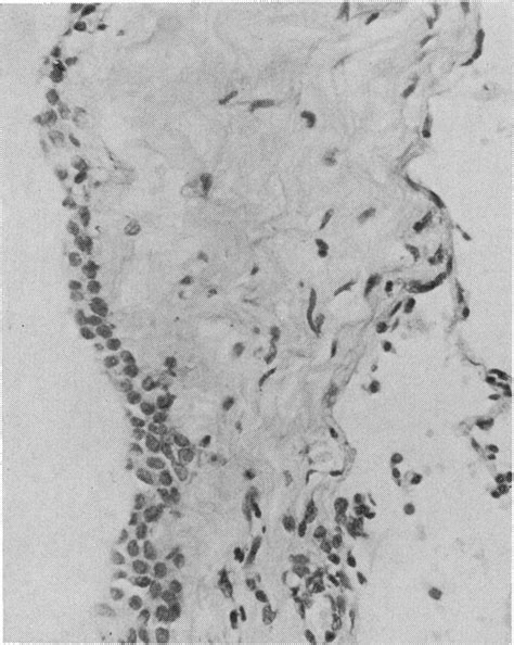 Slight Hyperplasia Of Visceral Pleural Mesothelium Close To An Area