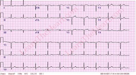 Old Anterior Wall Myocardial Infarction Mi Ecg Learn The Heart