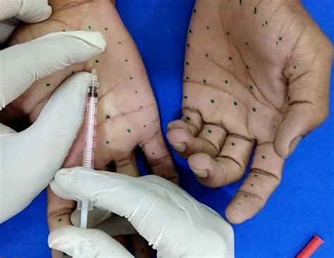 Hyperhidrosis Hands