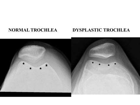 Trochlear Dysplasia Pptx