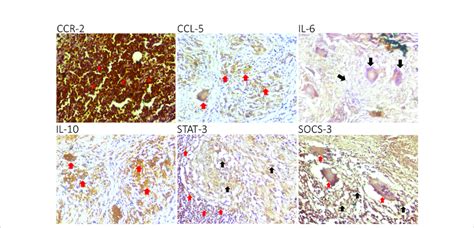 Epression Of C C Chemokine Receptor 2 Ccr 2 C C Chemokine Ligand 5
