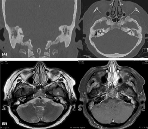 Osteomyelitis Of Skull Radiology At Phillip Hayes Blog