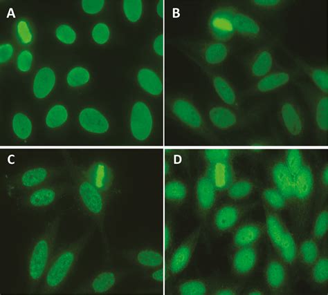 Speckled Antinuclear Antibody