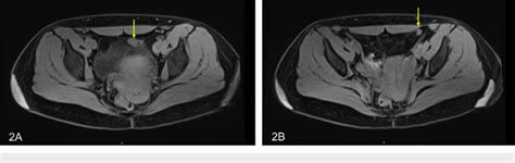 A Solid Aspect Peritoneal Implant In Close Contact With The Left