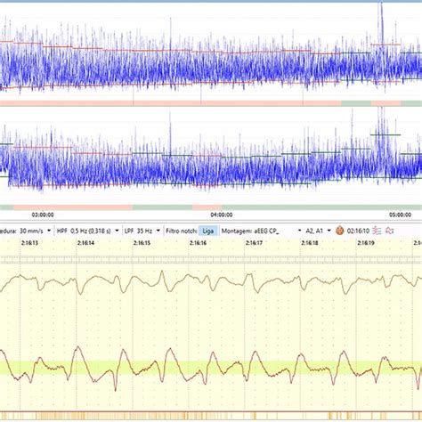An Example Of Seizures Displayed On Two Channel AEEG And Raw EEG Download Scientific Diagram