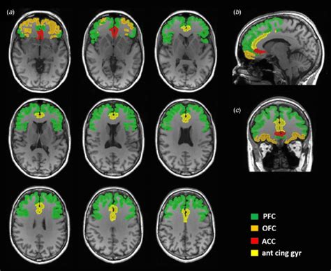 Masks For The Frontal Cortex The Mask Is Overlaid On A Structural Mri