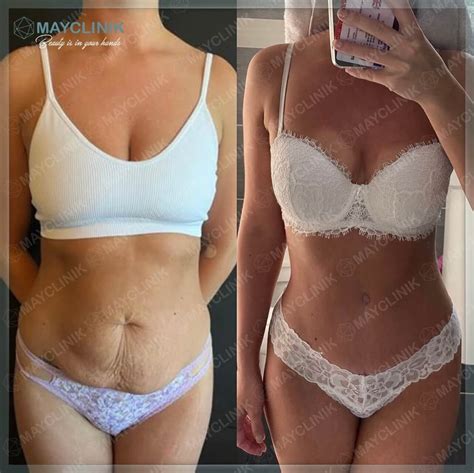 Tummy Tuck Turkey Cost 2024 Abdominoplasty Packages