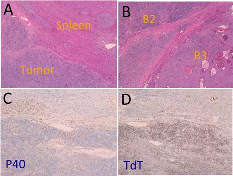 A Tumour Lower Left And Spleen Tissue Upper Right B Type B2 Download Scientific
