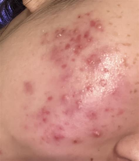 I Just Started Doxycycline But My Skin Feels Tight Hot Red A Slight