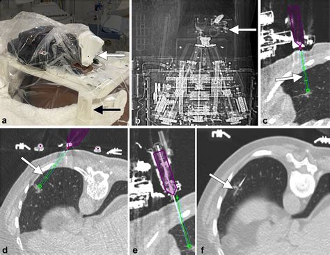 Comparison Of A Patient Mounted Needle Driving Robotic System Versus