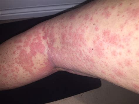 ‘bizarre Rash Leads To Cancer Diagnosis For Young Woman Globalnews Ca