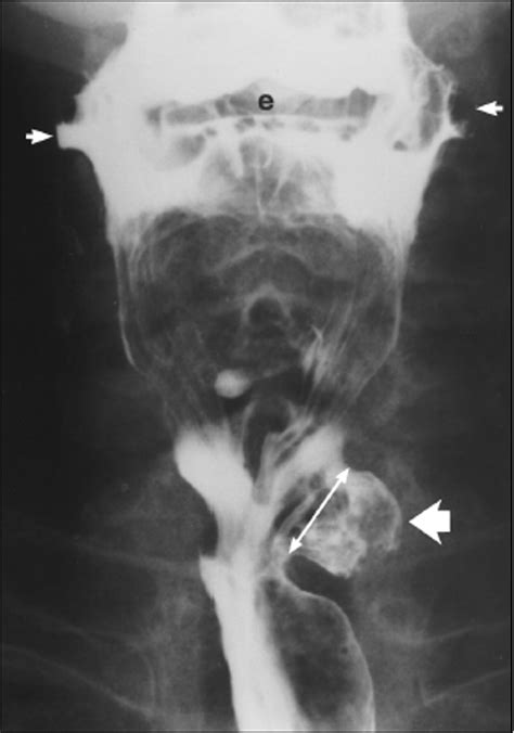 Killian Jamieson Diverticulum Laimers Diverticulum A Rare True