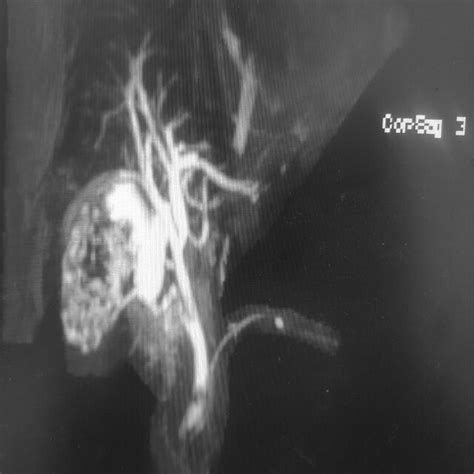 representative cholangiogram at the supine position from a 66 year old