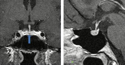 Pituitary Microadenoma Mri A Prolactinoma Case From Dr Blevins