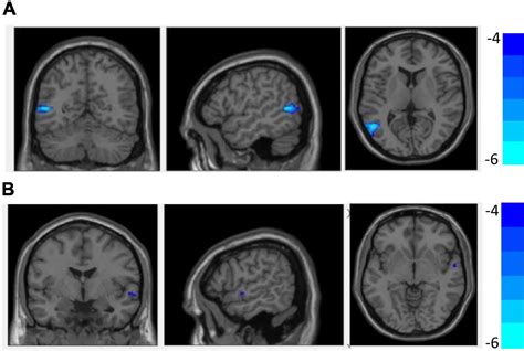 Frontiers Abnormal Brain Structure Morphology In 43 Off