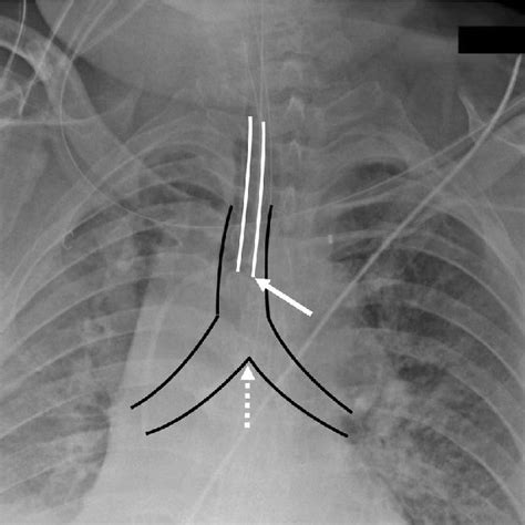 Frontal Chest Radiograph Single Frontal Radiograph Demonstrating