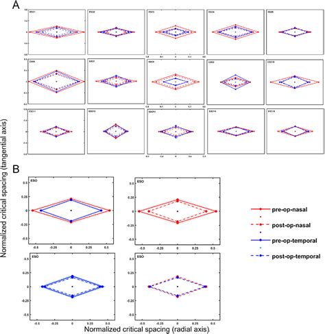 Figure 3 From Cortical Reorganization After Optical Alignment In