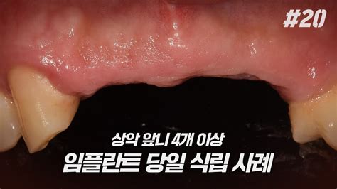 60대 환자의 상악 앞니 당일 임플란트 치료 사례 Youtube