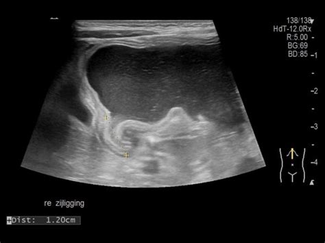Pylorus Hypertrofie Pittfall Ultrasound Cases