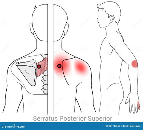 Serratus Posterior Superior Muscle Trigger Points Stock Illustration