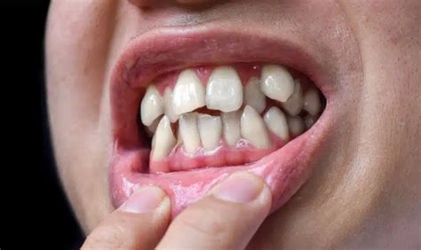 What Are The Treatment Options For Bad Teeth