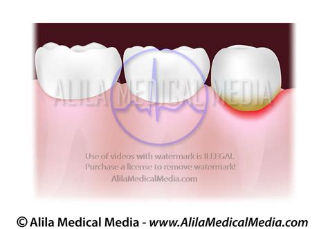 Alila Medical Media Gingivitis Medical Illustration