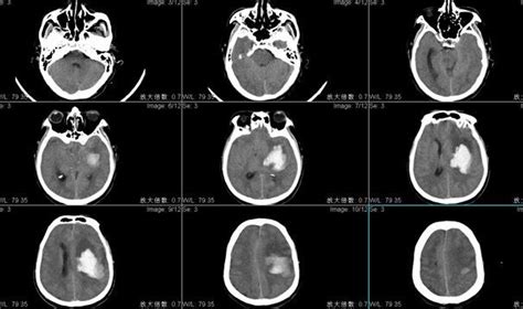 神经内镜辅助脑出血清除术 医联