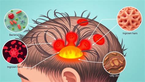 Scalp Folliculitis And Hair Loss How It Affects Your Scalp Health