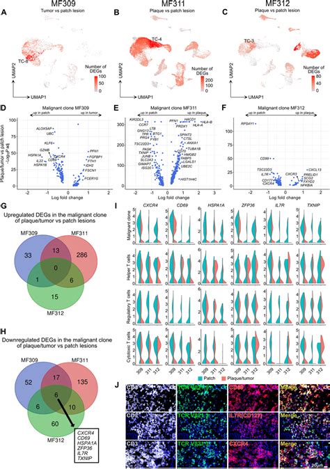Differential Gene Expression Between Plaquetumor And Patch Lesions Is