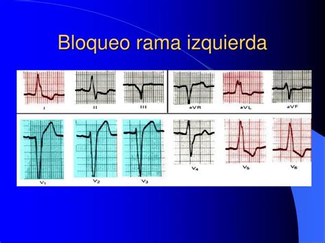 Ppt Arritmias Cardiacas Powerpoint Presentation Id 3824403