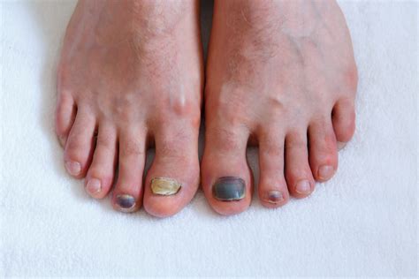 White Toenails From Nail Polish Causes And Best Treatment