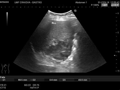 Liver Abscess 1 Image Efsumb