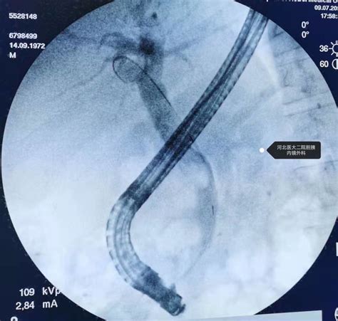 分享一例十二指肠乳头低位开口，憩室内乳头的ercp取石操作胆胰内镜网