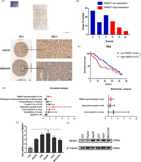 High Levels Of TM4SF1 Expression Are Associated With Poor Prognosis In