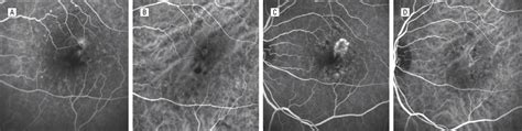 Stage 1 Retinal Angiomatous Proliferation Rap Angiograms Obtained At