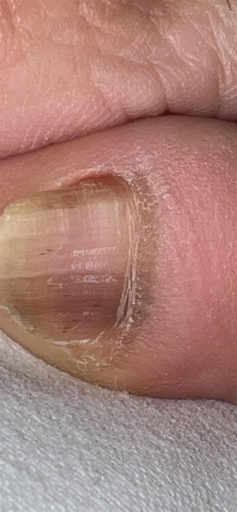 My Struggle And Success With Treating Foottoenail Fungus Rnailfungus
