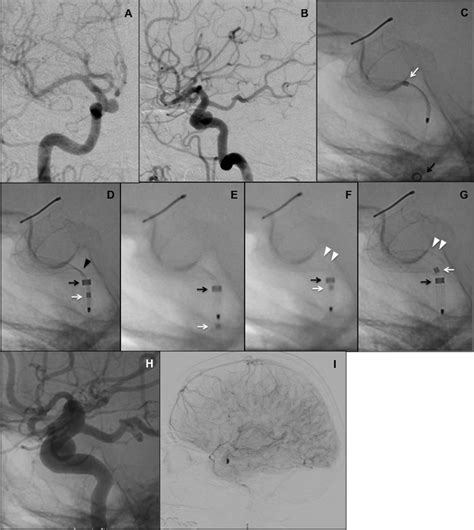 Intra Dic Distal Intracranial Catheter Deployment Of The Pipeline Embolization Device A Novel