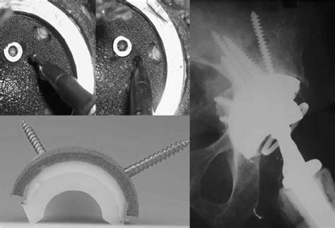 The Porous Tantalum — Trabecular Metal Tm — Revision Acetabular Shell Download Scientific