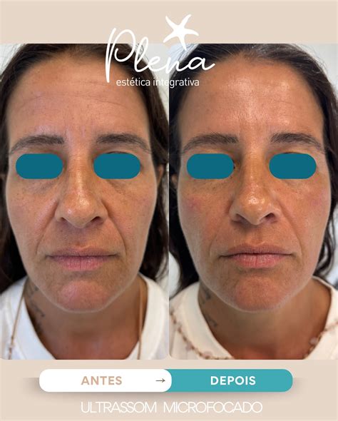 Plena Estética Avançada Ultrassom Microfocado Uma Semana Recheada