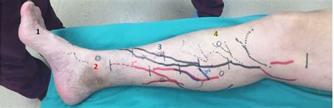 Icg Lymphography Mapped Lymphatics Are Shown In The Lower Extremity