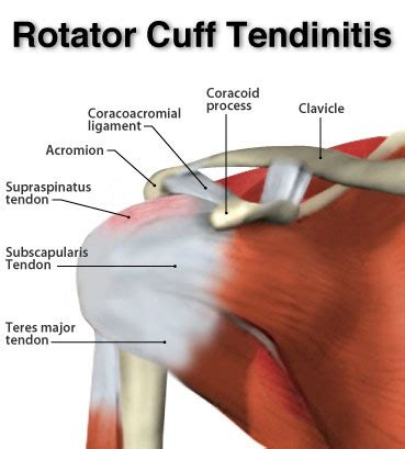 What Is Rotator Cuff Tendinitis Form Function Physiotherapy