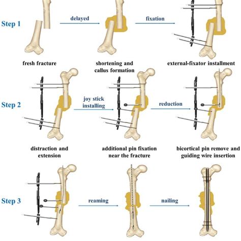 Diagram Of The Minimally Invasive Fixator Assisted Nailing Technique Download Scientific