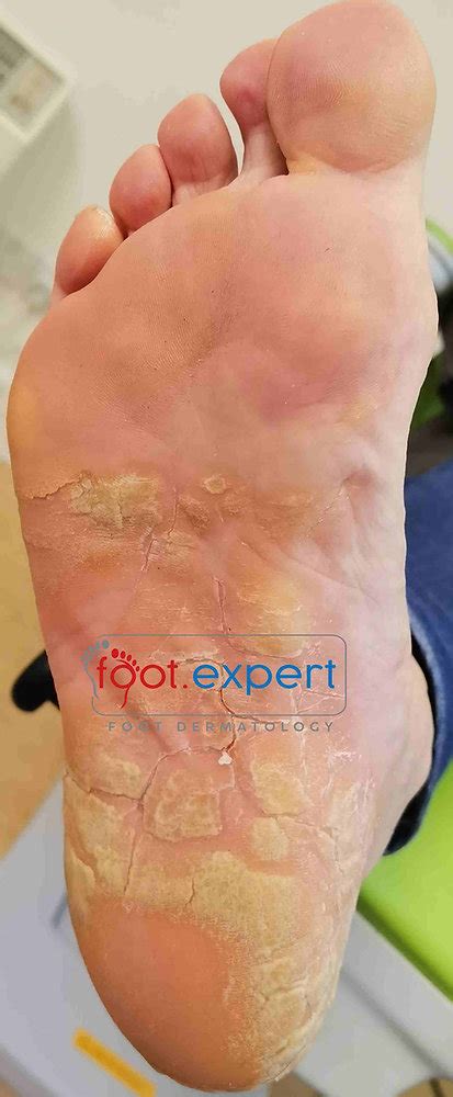 Keratoderma Climactericum Another Cause Of Plantar Hyperkeratosis