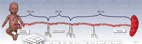 The Umbilical Cord Arranged In A Helical Structure Do