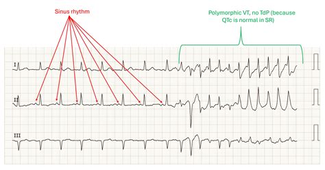 Polymorphic Ventricular Tachycardia Ecg Guru Instructor Resources