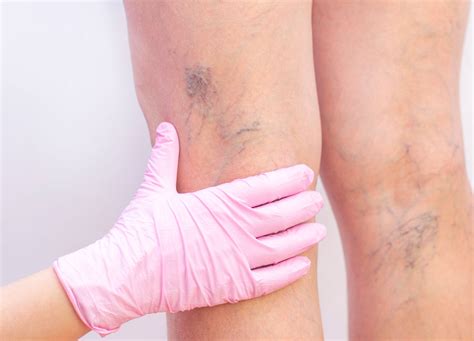 Thread Veins Skin Health And Allergy Conditions