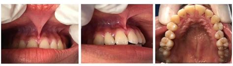 Figure 1 From Management Of Frenectomy Anterior Upper Arch Before
