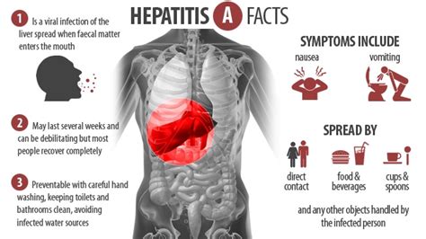 The Hepatitis A Outbreak Highly Contagious Virus In The Jewel Of